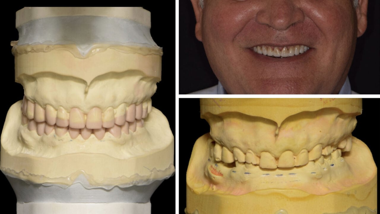 Tooth Wear: Why It Happens And What To Do | Parker Dental Implant And ...